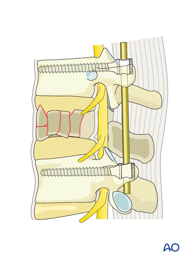Posterior decompression techniques in the thoracolumbar spine
