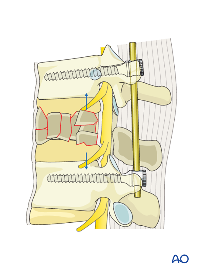 Posterior decompression techniques in the thoracolumbar spine