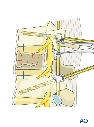 Posterior decompression techniques in the thoracolumbar spine