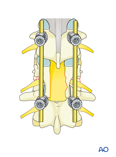 Posterior decompression techniques in the thoracolumbar spine