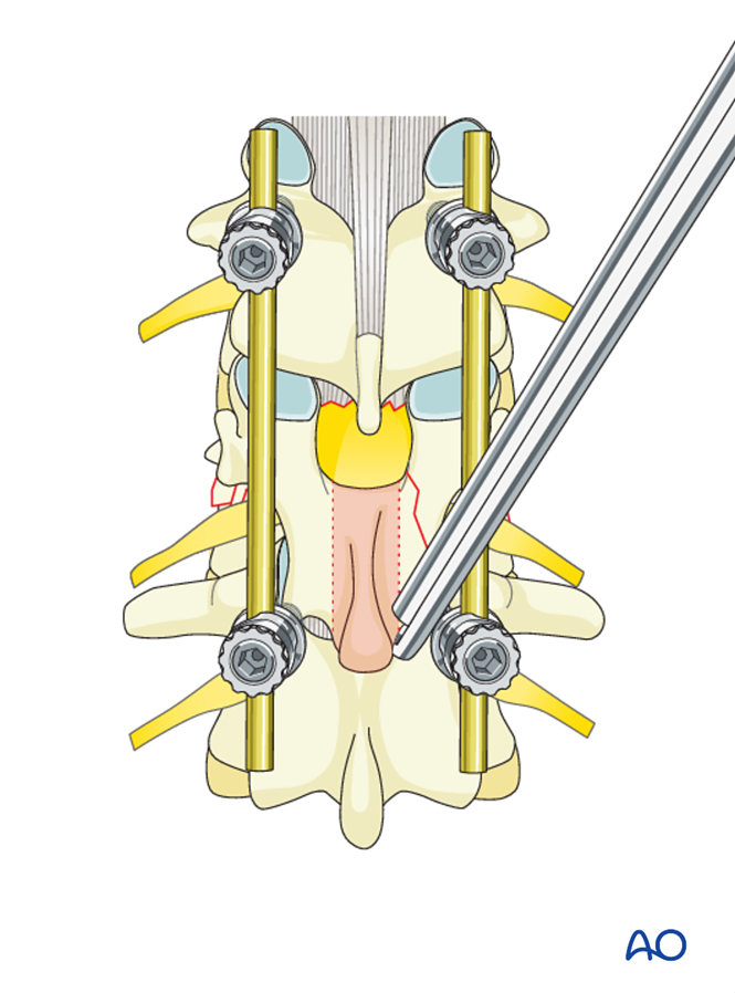 Posterior decompression techniques in the thoracolumbar spine