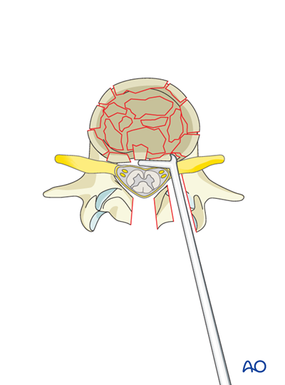 Posterior decompression techniques in the thoracolumbar spine
