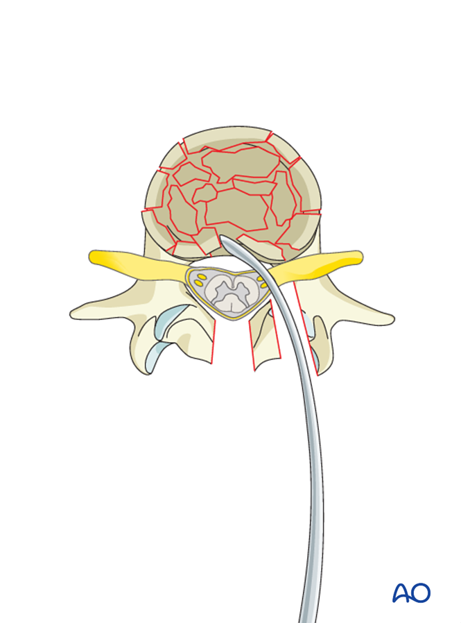 Posterior decompression techniques in the thoracolumbar spine