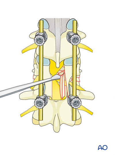 Posterior decompression techniques in the thoracolumbar spine