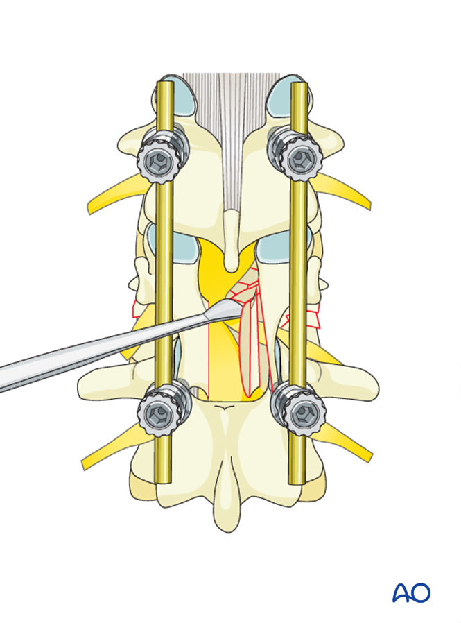 Posterior decompression techniques in the thoracolumbar spine