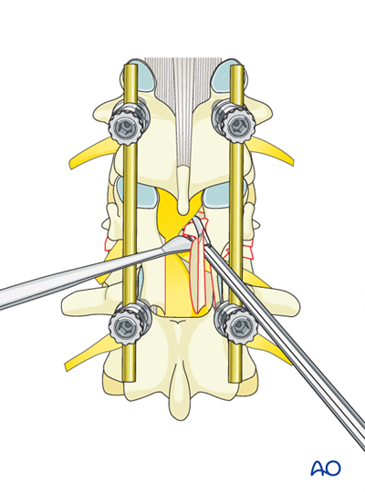 Posterior decompression techniques in the thoracolumbar spine