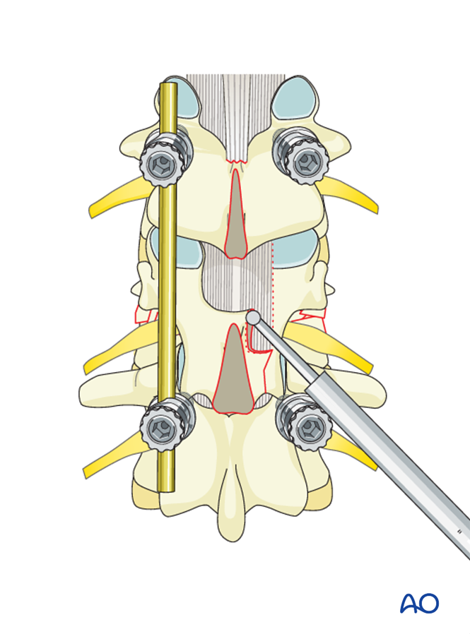 Posterior decompression techniques in the thoracolumbar spine