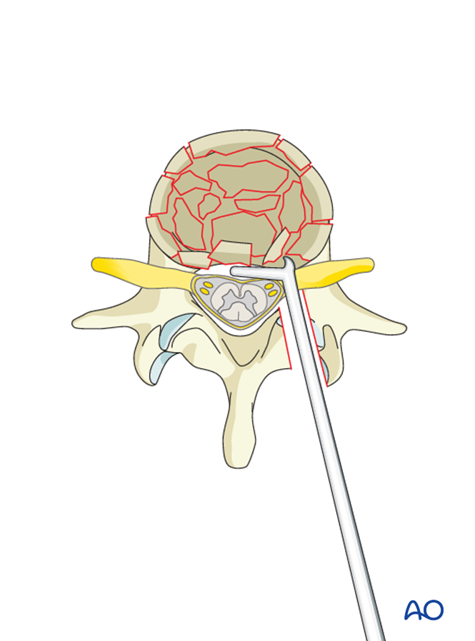 Posterior decompression techniques in the thoracolumbar spine