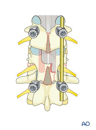 Posterior decompression techniques in the thoracolumbar spine