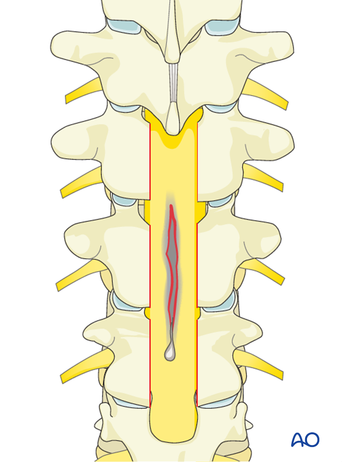 Repair of dural laceration in the spine