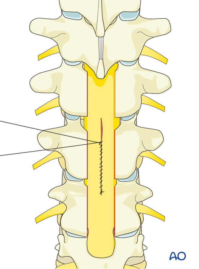 Repair of dural laceration in the spine