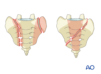 Posterior midline approach to the sacrum