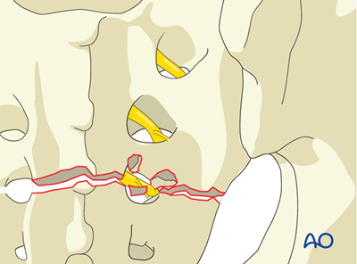 ORIF - Sacral alar plating for A3 Displaced transverse fracture below ...
