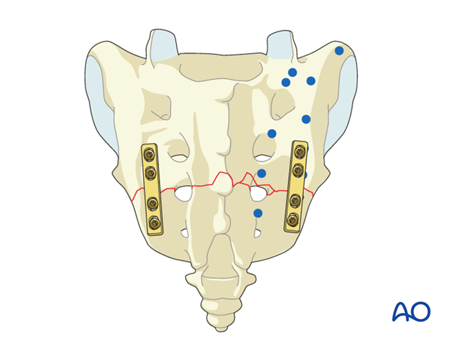 ORIF - Sacral alar plating for A3 Displaced transverse fracture below ...
