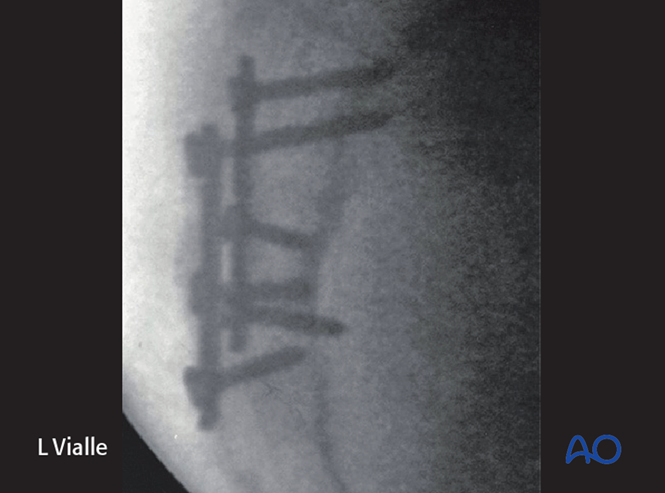 ORIF - Sacral alar plating for A3 Displaced transverse fracture below ...