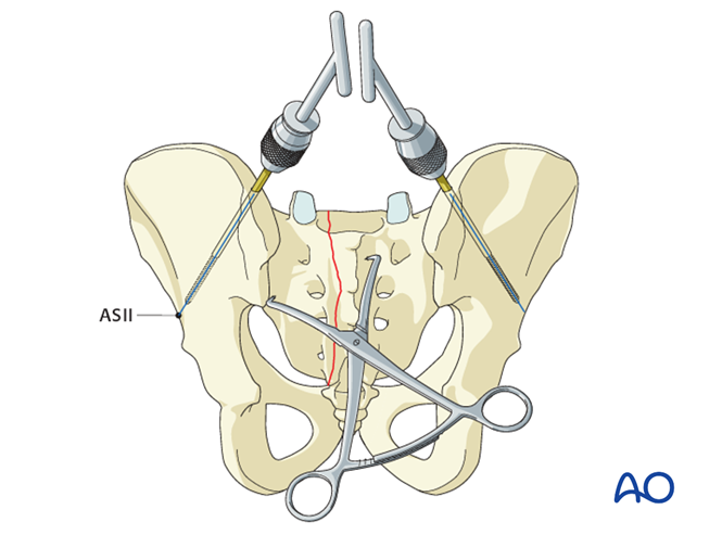 Spinopelvic fixation for B1 Central fracture