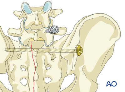 Spinopelvic fixation for B1 Central fracture