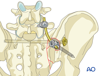 Spinopelvic fixation for B2 Transalar fracture