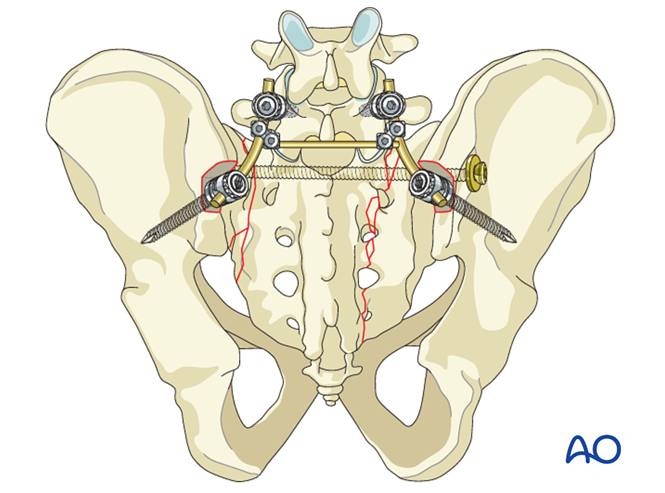 Spinopelvic fixation for C2 Bilateral type B injury