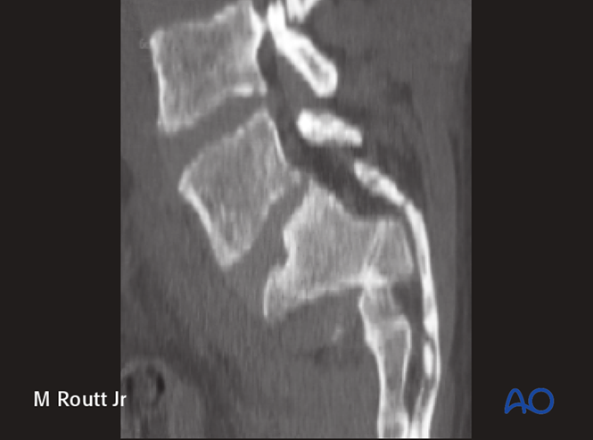 Spinopelvic fixation for C3 Displaced sacral U-type fracture