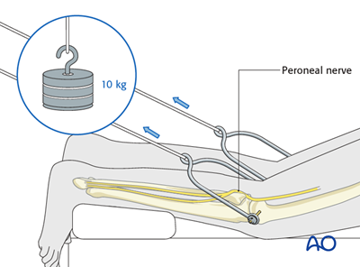 Spinopelvic fixation for C3 Displaced sacral U-type fracture