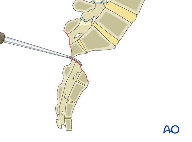 Spinopelvic fixation for C3 Displaced sacral U-type fracture