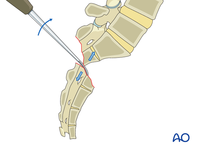 Spinopelvic fixation for C3 Displaced sacral U-type fracture