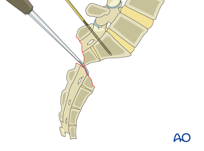 Spinopelvic fixation for C3 Displaced sacral U-type fracture