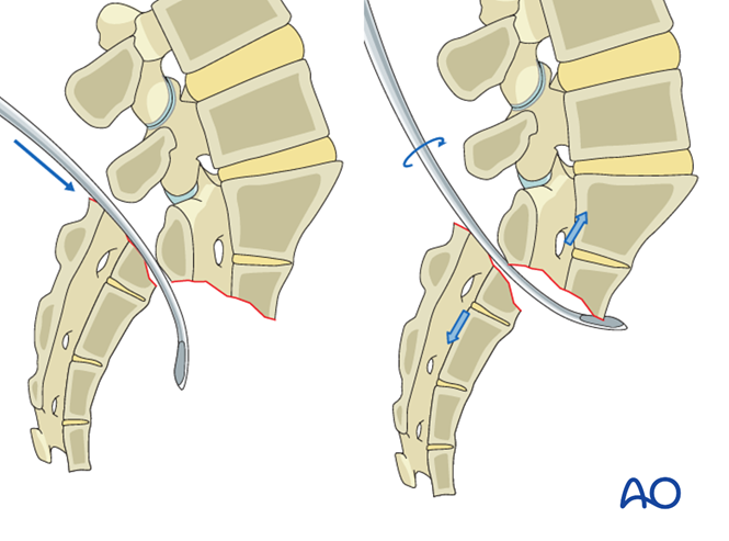 Spinopelvic fixation for C3 Displaced sacral U-type fracture