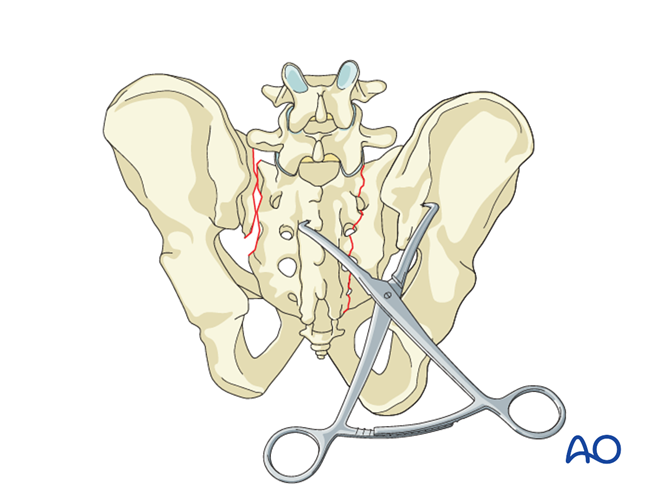 Spinopelvic fixation for C2 Bilateral type B injury