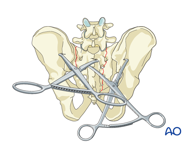 Spinopelvic fixation for C2 Bilateral type B injury