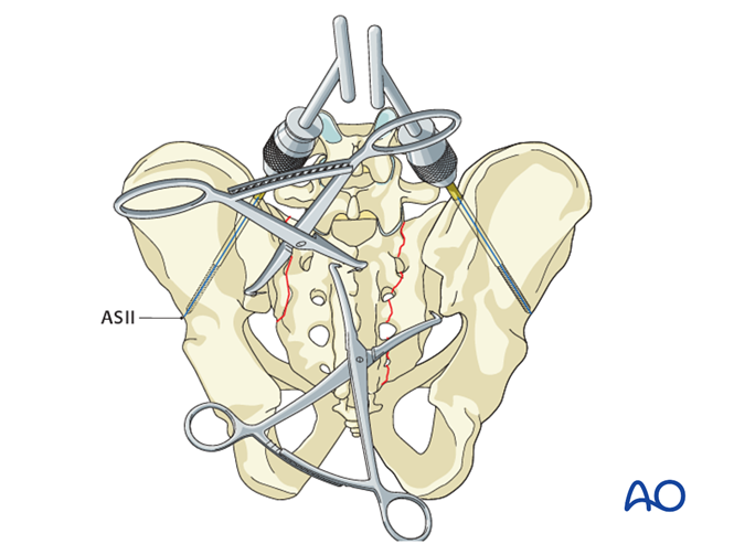Spinopelvic fixation for C2 Bilateral type B injury
