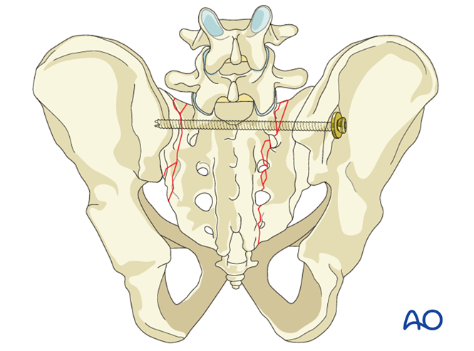 Spinopelvic fixation for C2 Bilateral type B injury