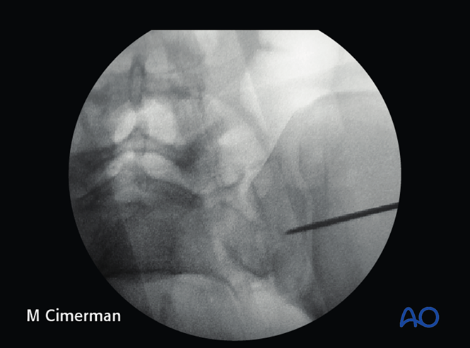 Iliosacral screw insertion