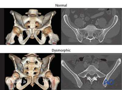 Planning for IS screw insertion