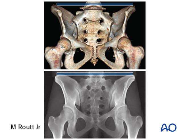 Planning for IS screw insertion
