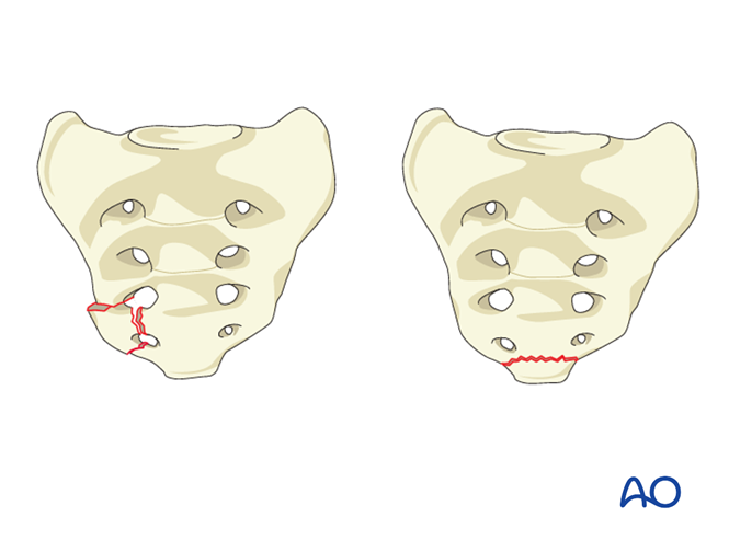 AOSpine classification
