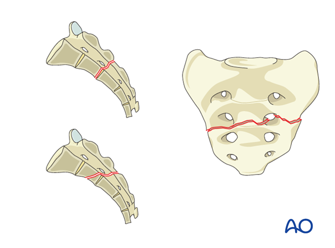 AOSpine classification