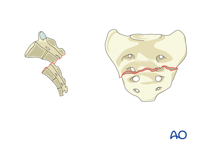 AOSpine classification
