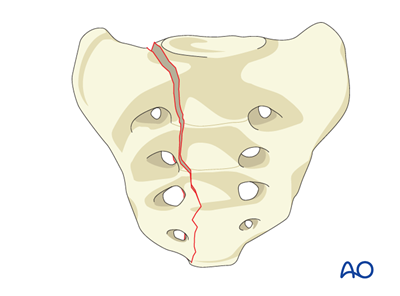AOSpine classification