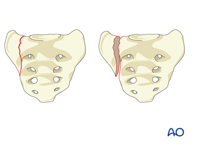 AOSpine classification