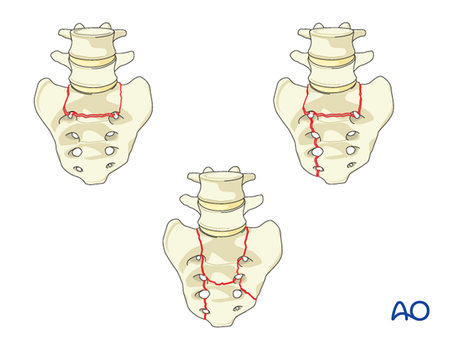 AOSpine classification