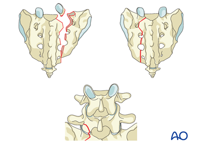 AOSpine classification