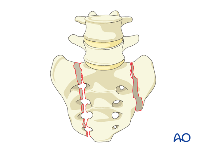 AOSpine classification
