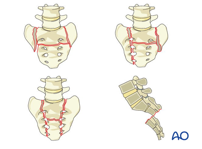 AOSpine classification