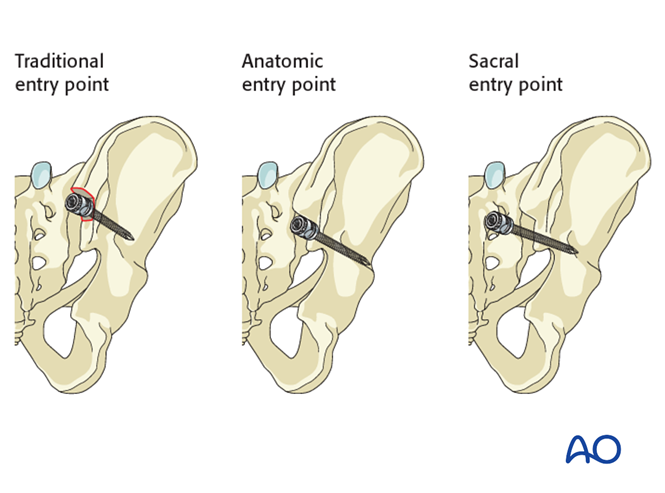 Basic techniques for management of sacral trauma
