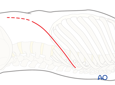 Anterior approach to the lumbar spine