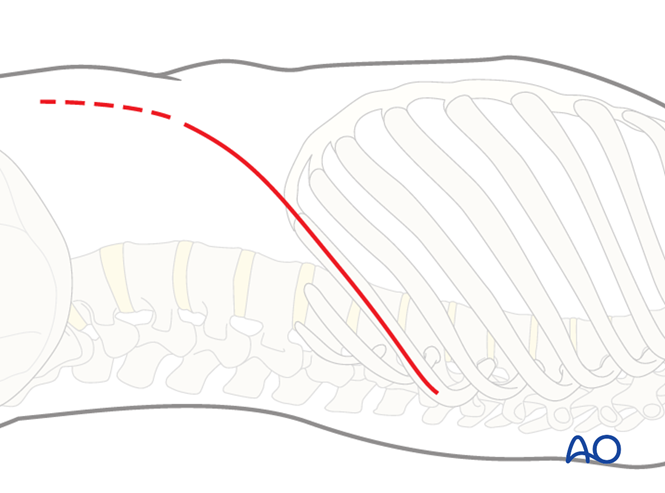 Anterior approach to the lumbar spine
