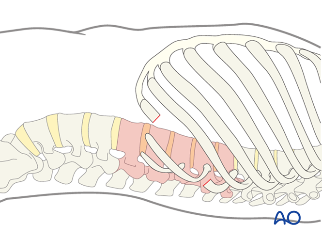Anterior approach to the lumbar spine