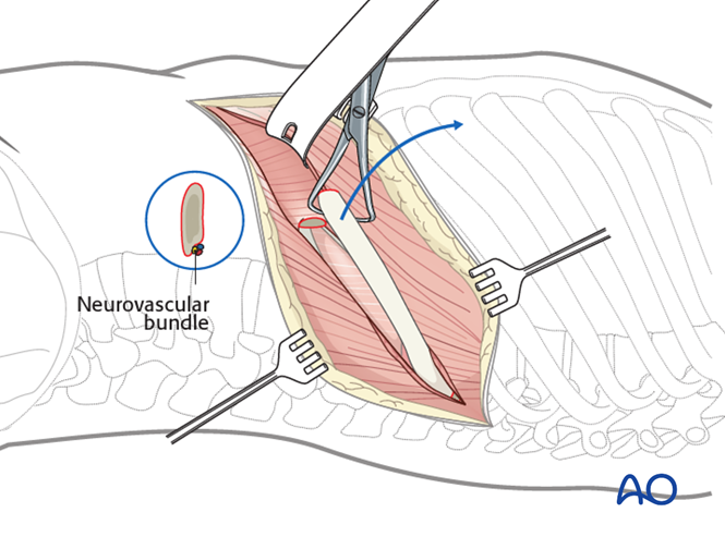 Anterior approach to the lumbar spine